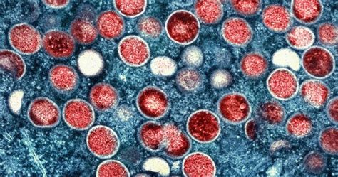 Mpox Is No Longer A Global Health Emergency Who Declares National Globalnewsca