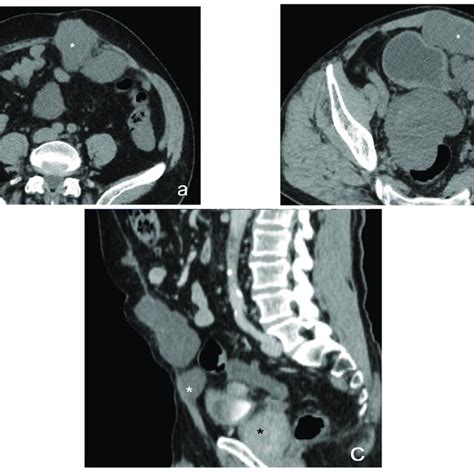 Contrast Enhanced CT Scan Axial View A B And Sagittal View C Case