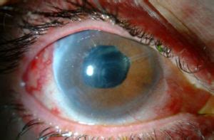 Glaucoma qué es síntomas causas y tratamiento APEC Blog