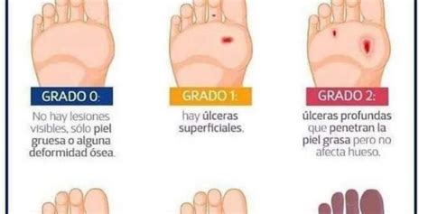 GRADOS DE LESIÓN EN EL PIE DIABÉTICO Blog de Fisioterapia