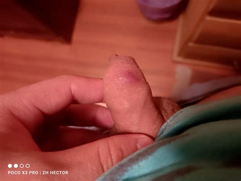 Bulto En El Pene