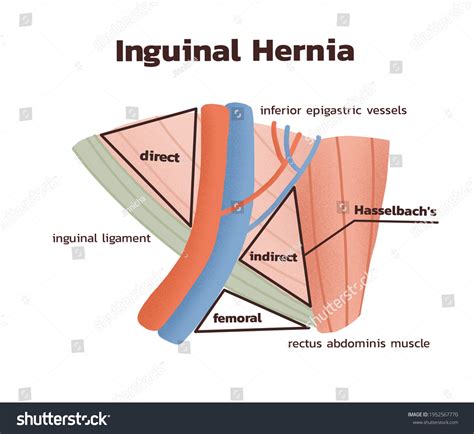 Minimal Illustration Direct Indirect Inguinal Hernia Stock Illustration