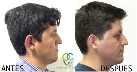 Cirugía Ortognatica Orthodontics City