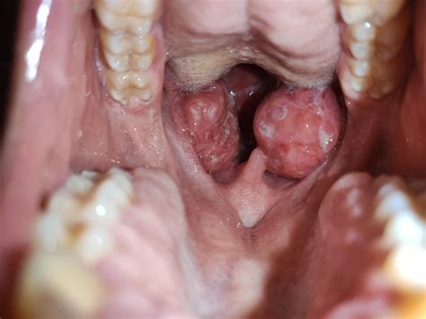 Placas De Pus Na Garganta Causas E Como Tirar