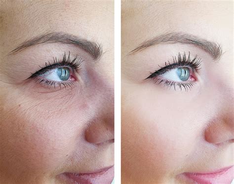 Laser Skin Resurfacing Co Laser Skin Resurfacing Flei