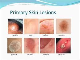 Primary Skin Lesion Names