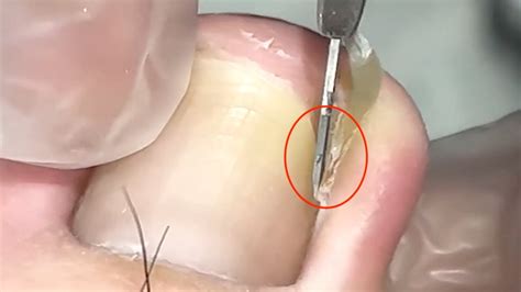 Daily Pedicure TutorialUnimaginable A Large Circular Ingrown Nail