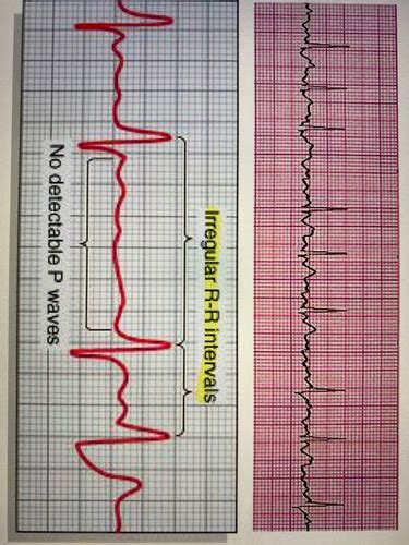Arrhythmias Flashcards Quizlet