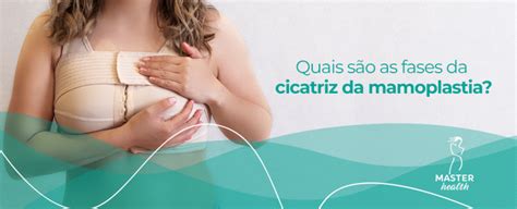 Fases Da Cicatriz De Mamoplastia Blog Master Health