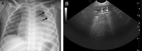 Interventional Management Of Pleural Infections CHEST