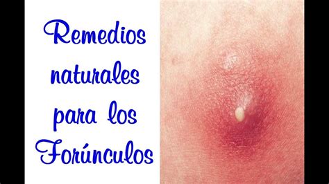 Remedios Naturales para los Forúnculos YouTube