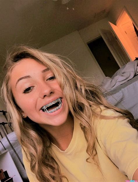 Pin By Marie On Lol Braces Colors Teeth Braces Cute Braces