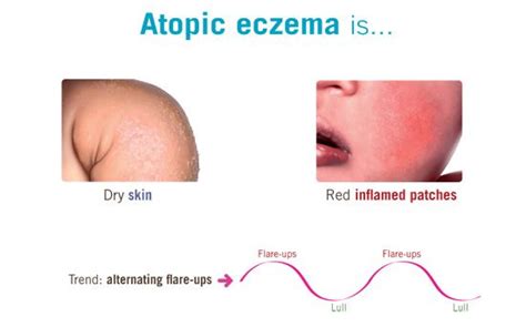 Atopic Dermatitis Eczema Infographic Interesting Facts Skin