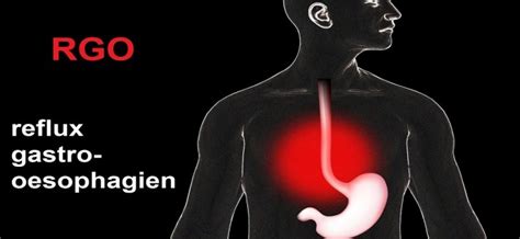 Le reflux gastro œsophagien RGO Actualités Sante dz