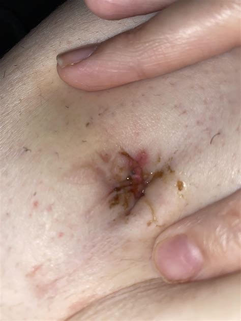Infected Laparoscopic Incision