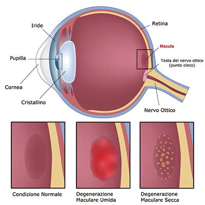 La Maculopatia Oculus Centro Oculistico Laser
