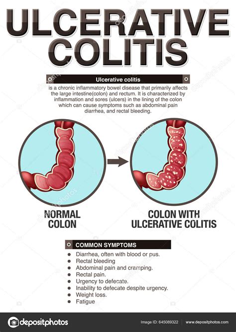 Colitis Ulcerosa Síntomas Infografía Ilustración Stock Vector by