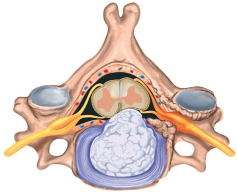 Cervical Disc Herniation Cervico Brachialgia Back Center Geneva