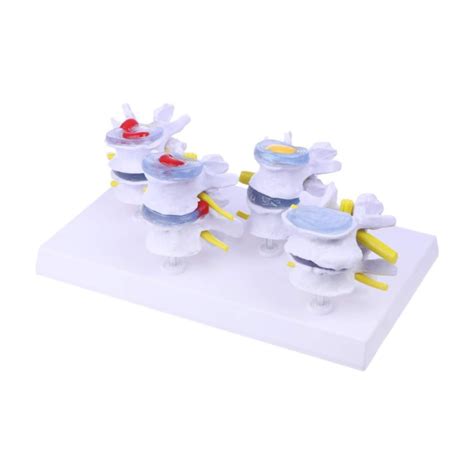 Maqueta Demostraci N Hernia Discal Hm Medical