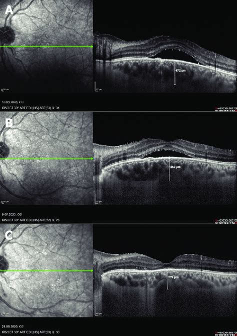 Enhanced Depth Imaging Optical Coherence Tomography EDI OCT Images