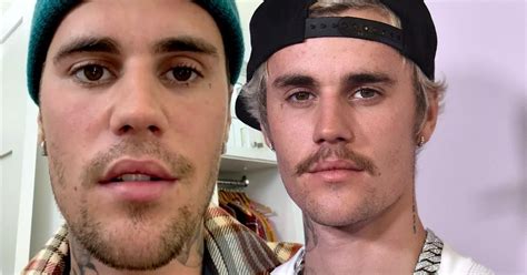 How Did Justin Bieber S Face Get Better After Suffering From Facial