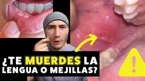 Te muerdes la lengua o mejillas con frecuencia Causa y solución YouTube