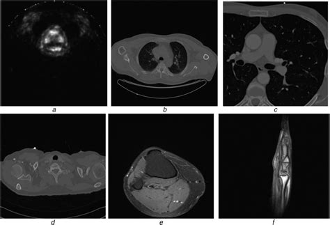 three‐dimensional separate descendant‐based spiht algorithm for fast compression of high
