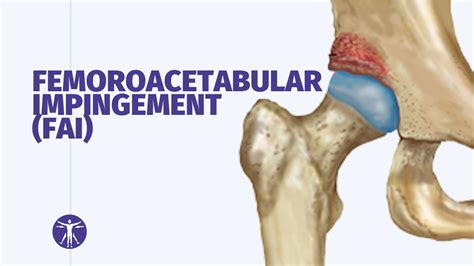 Femoroacetabular Impingement FAI Diagnosis Treatment