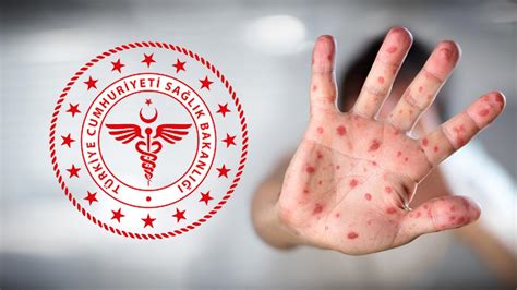 Maymun Çiçeği virüsü nedir nasıl bulaşır Belirtileri ve korunma