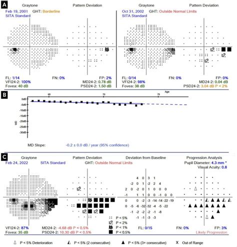 Glaucoma Visual Field