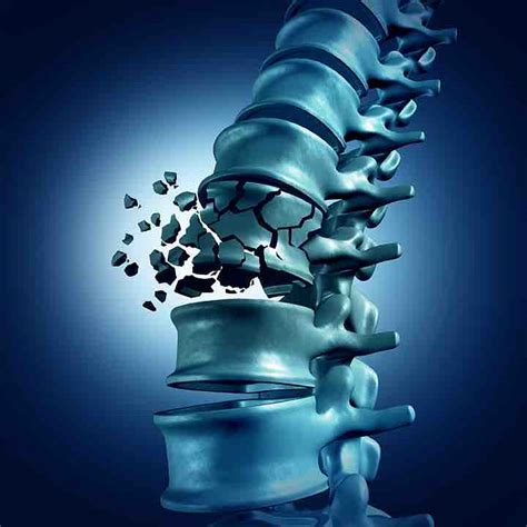 Tratamiento Para Osteoporosis Doctor Carlos Ochoa