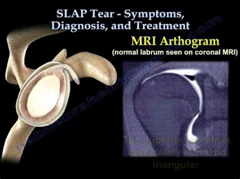 SLAP Tear Symptoms Diagnosis And Treatment Everything You Need To