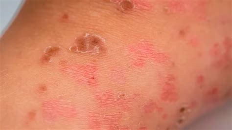 Alerta en Hidalgo por virus Coxsackie Qué es y cuáles son los