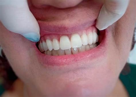 Próteses Só Sorriso Odontologia Recreio do Bandeirantes Freguesia