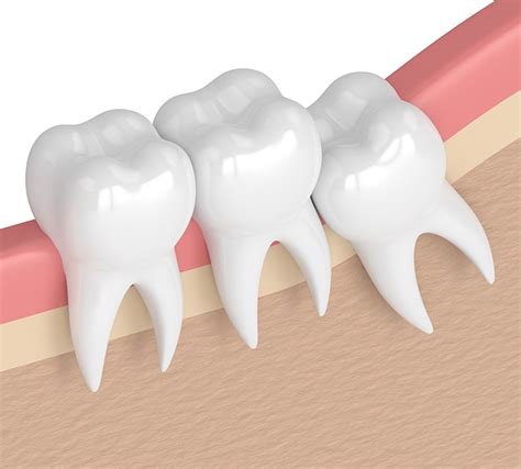 Muelas del juicio cuándo hay que extraerlas Sanz Clínica Dental