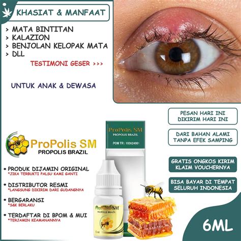 Jual Obat Mata Bintitan Kalazion Benjolan Di Kelopak Mata Pada Anak Dan