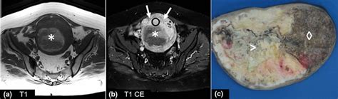Leiomyosarcoma In A 71 Year Old Woman Axial T1 Weighted Image A And