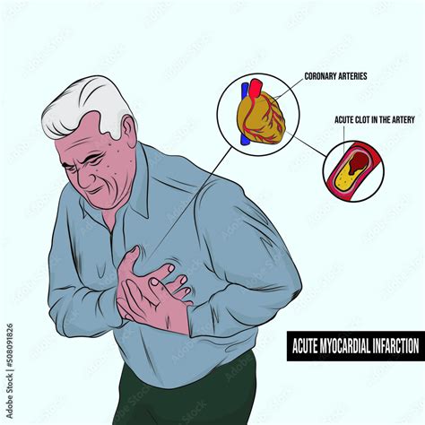 Acute Myocardial Infarction Is An Acute Coronary Syndrome It Is The