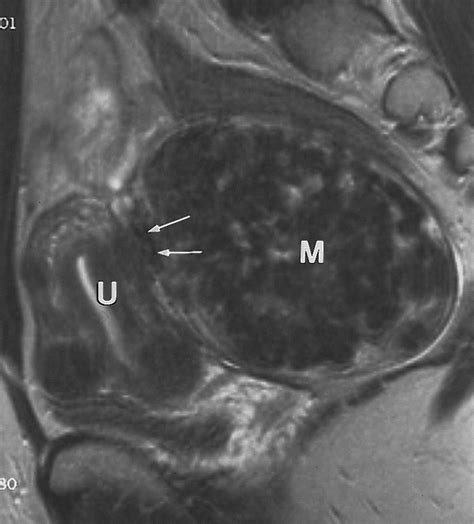 CT And MR Imaging Of Ovarian Tumors With Emphasis On Differential