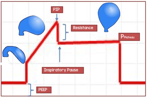 Simplifying Mechanical Ventilation Part I Types Of Breaths REBEL