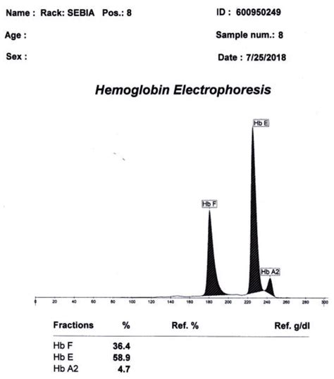 Cze Pattern Of Hemoglobins Of Hbe O Thalassemia Composing Of A Ef