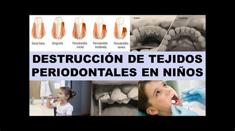 DESTRUCCIÓN DE TEJIDOS PERIODONTALES EN NIÑOS YouTube