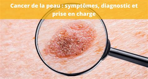 Cancer de la peau Symptômes diagnostics traitements et taux de survie