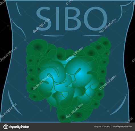 Sobrecrecimiento Bacteriano Del Intestino Delgado Sibo Ilustración