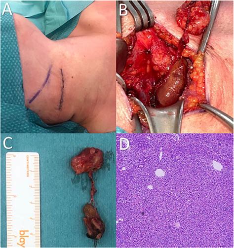 Submandibular Ectopic Parathyroid Adenoma A Case Report Jose Antonio