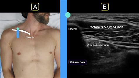 Clavipectoral Block Highland EM Ultrasound Fueled Pain Management