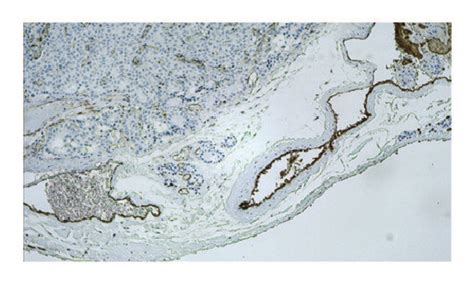 Parathyroid Adenoma A The Patient Underwent Minimally Invasive