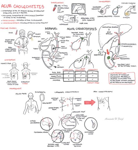 Acute Cholecystitis Armando Hasudungan Nursing School Studying