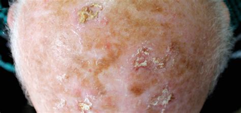 Actinic Keratosis Solar Keratosis Sun Spots Dermatolo