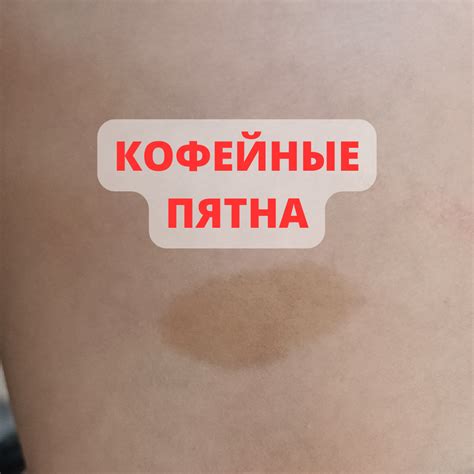 Кофейные пятна на коже Советы дерматолога Sovetydermatologa Дзен